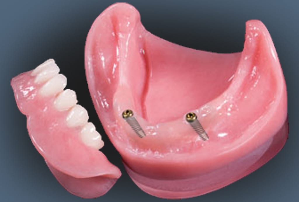 Dentures and Partials | Cosmetic Dentist San Diego